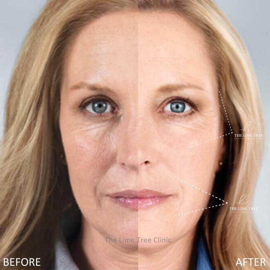 Collagen Stimulator Injections Perth | Induction Therapy