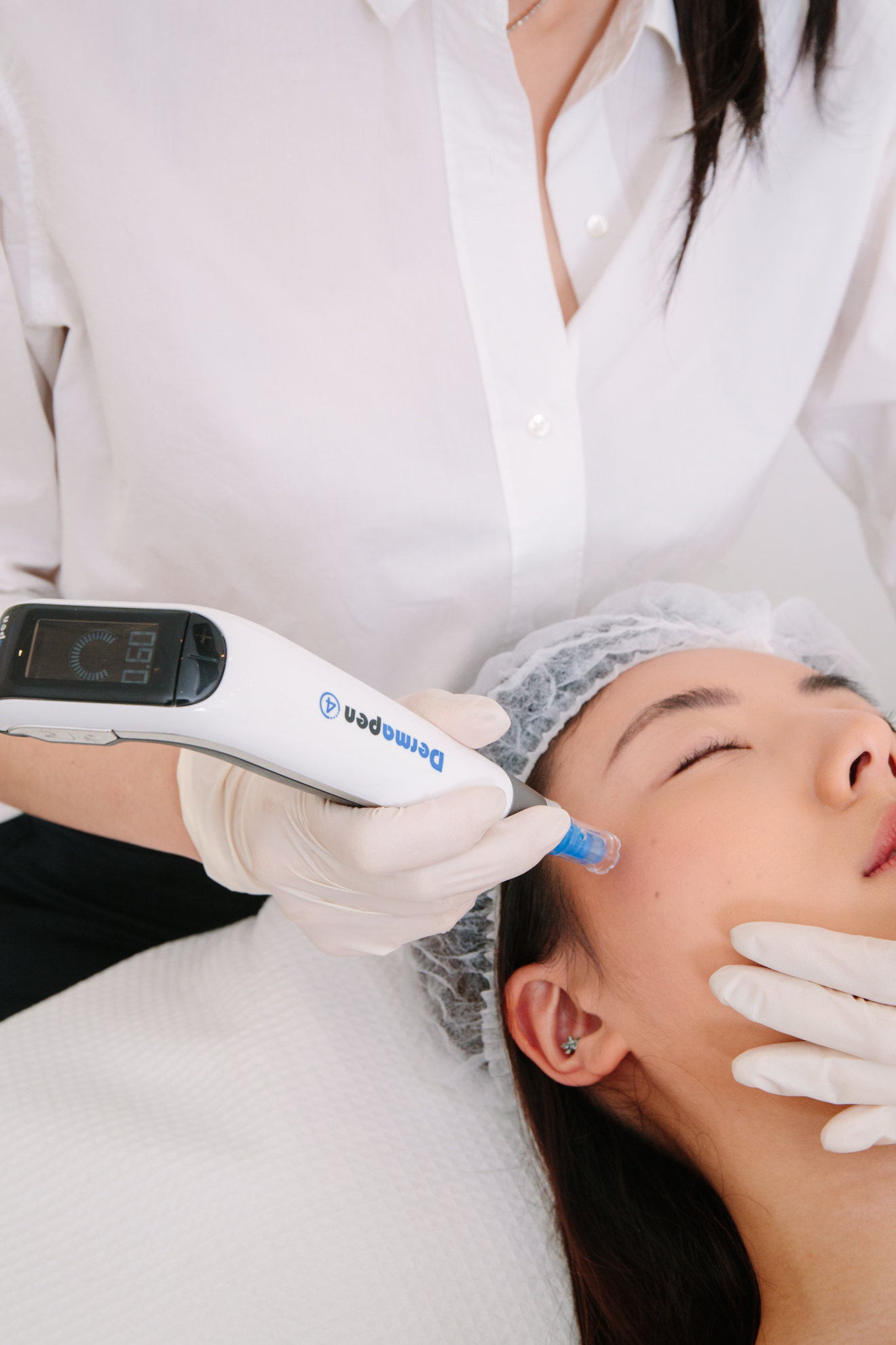 Skin Needling Perth | Dermapen Micro Needling Treatments