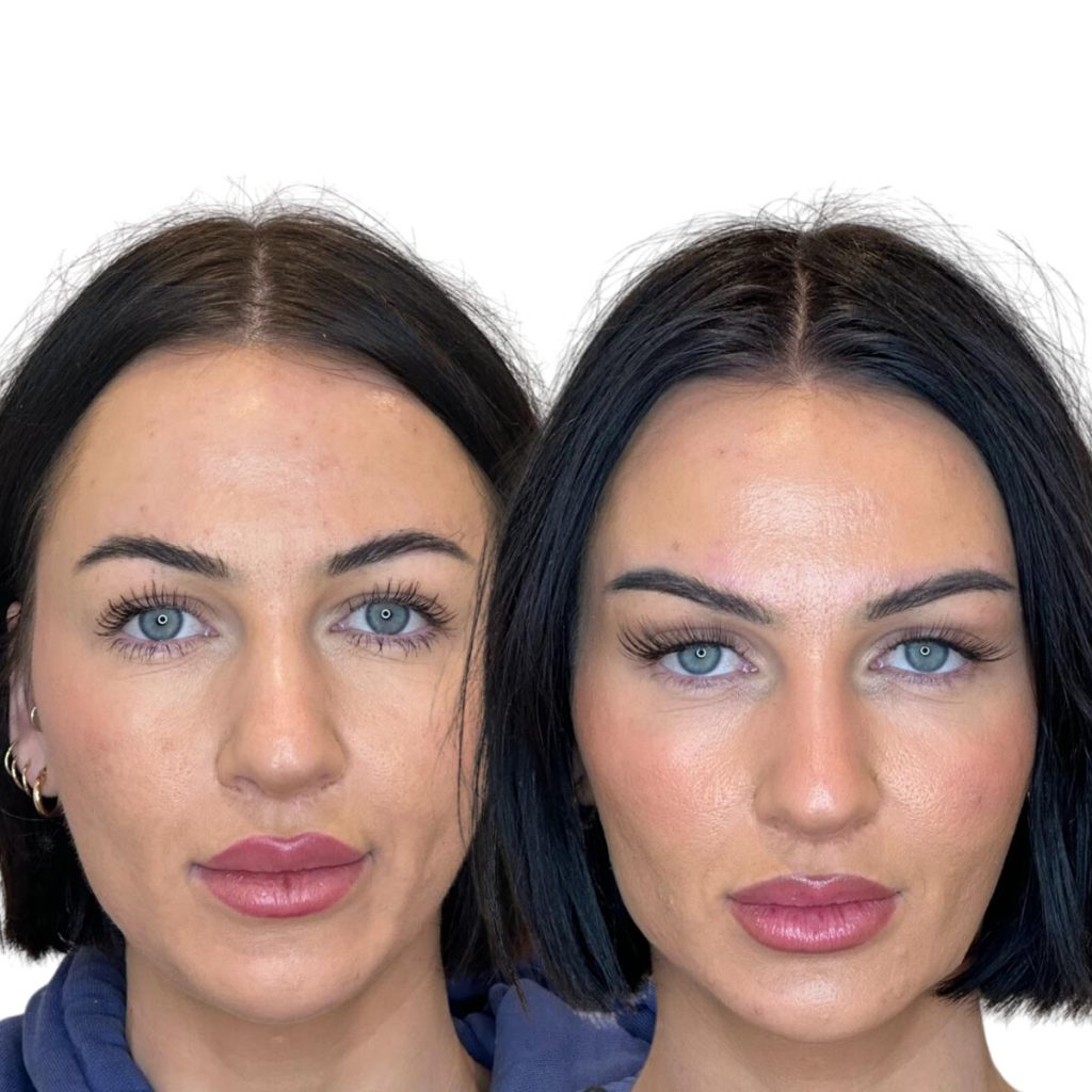 Thread Lift Perth | PDO Non-Surgical Face & Eyebrow Lift