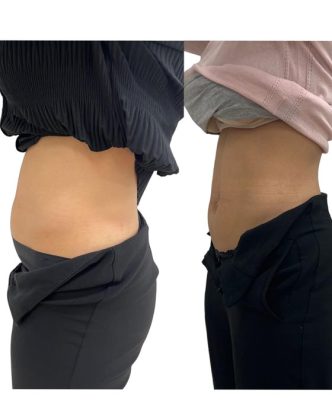 Emsculpt NEO Perth | Fat & Body Sculpting Clinic – Contact Us