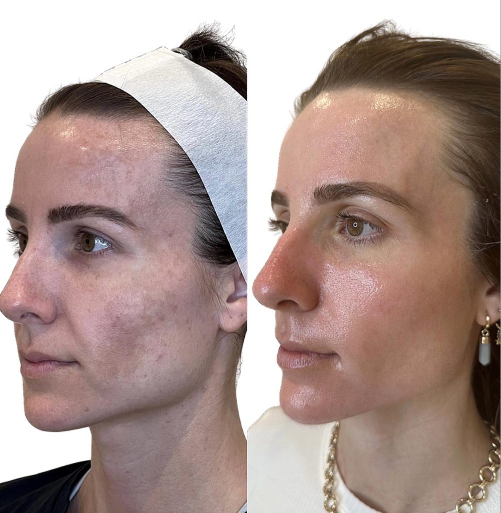 Dermamelan | The Lime Tree Clinic