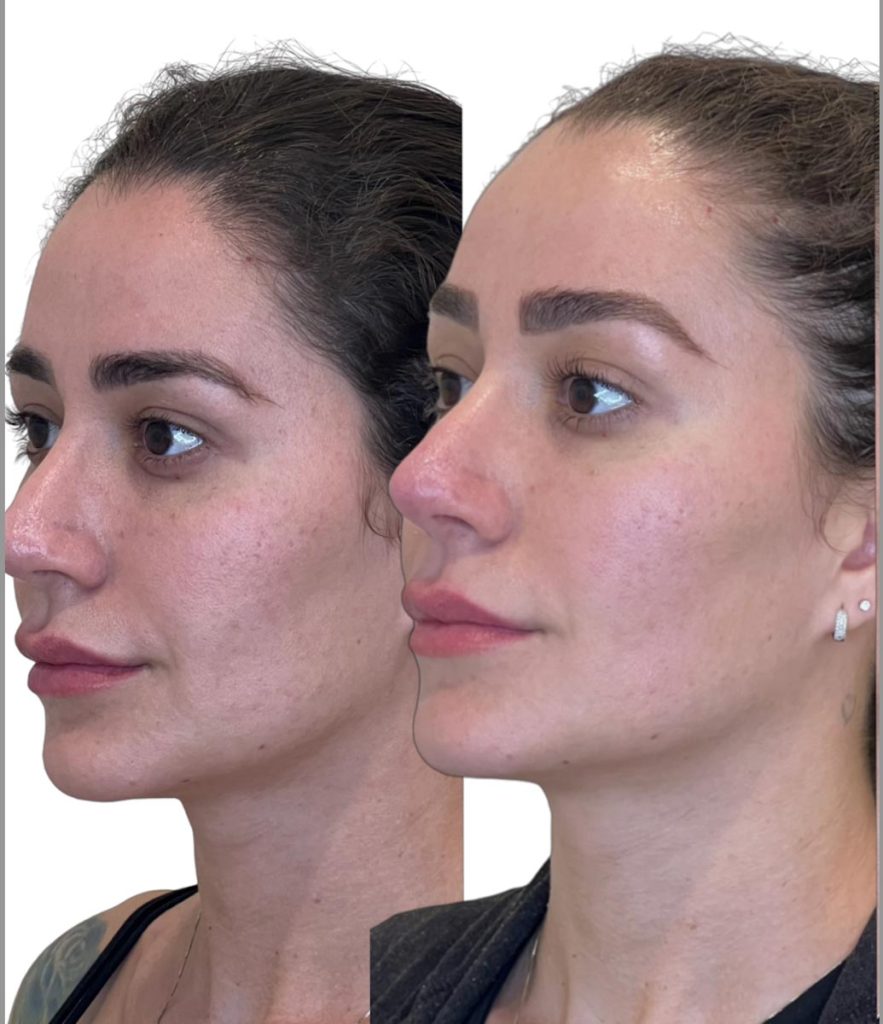 Collagen Stimulator Injections Perth | Induction Therapy