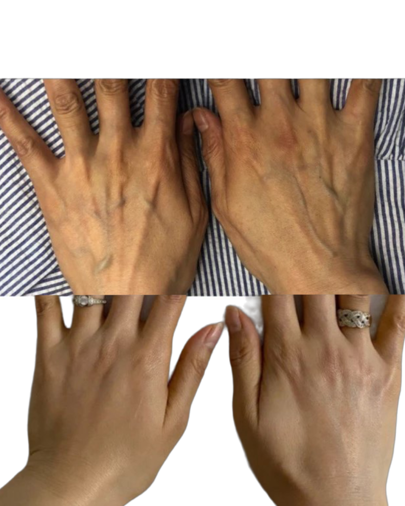 Collagen Stimulator Injections Perth | Induction Therapy