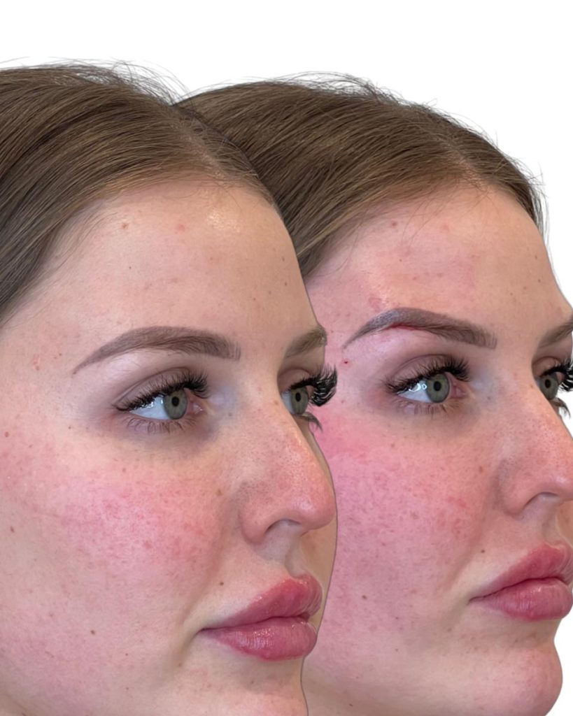 Thread Lift Perth | PDO Non-Surgical Face & Eyebrow Lift