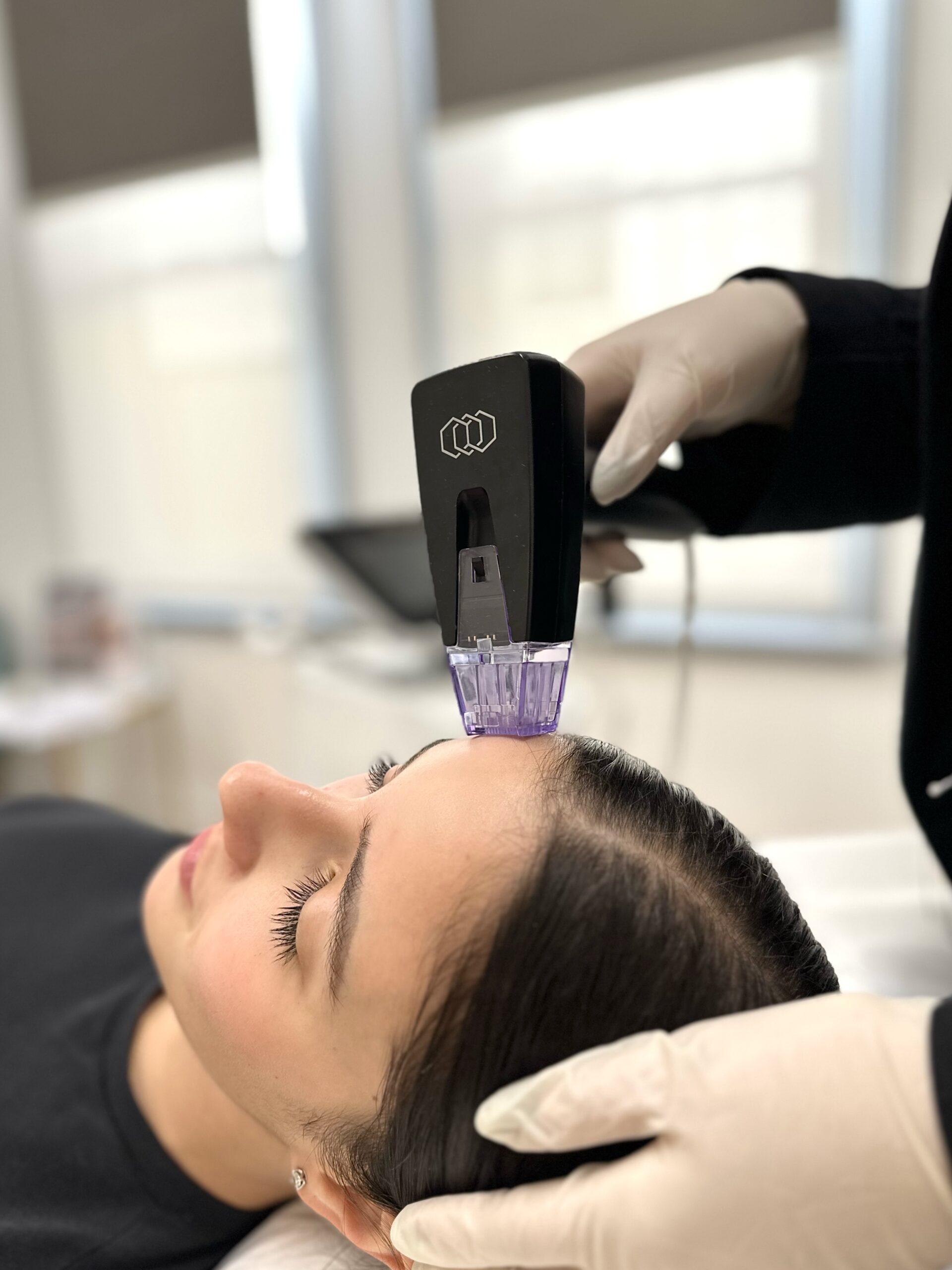 Morpheus8 Perth | Radiofrequency RF Microneedling