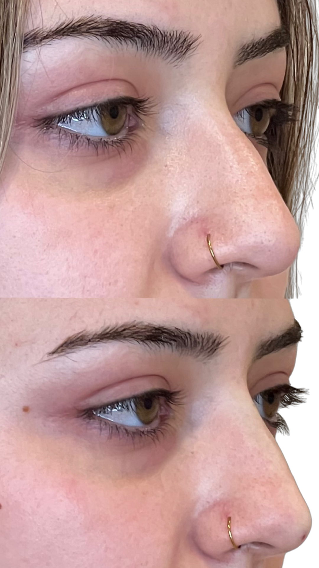 Nose Shaping Thread Lift | The Lime Tree Clinic