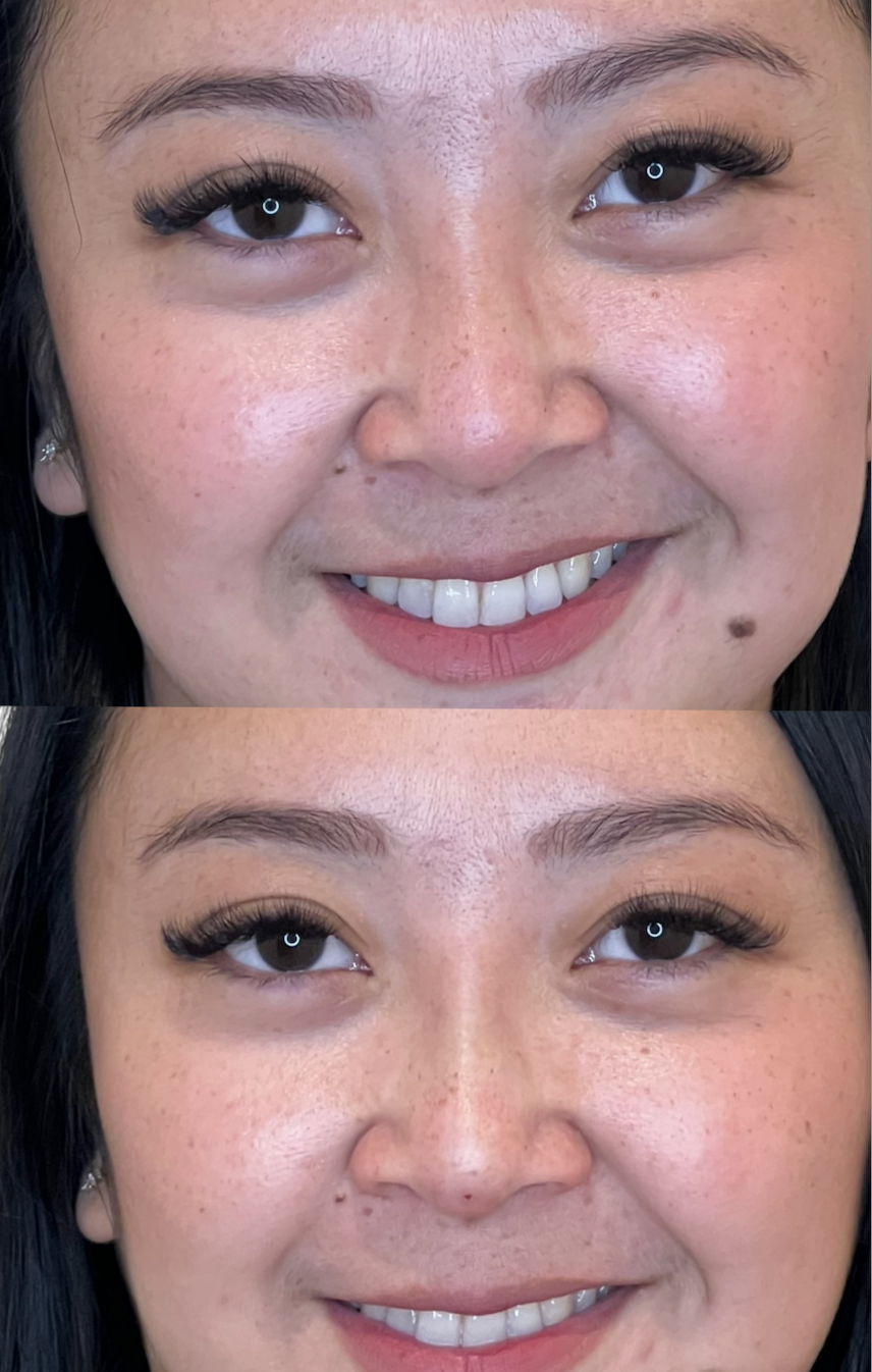 Nose Shaping Thread Lift | The Lime Tree Clinic